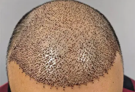 Hair Transplant Scabs: How To Make Them Go? | Longevita