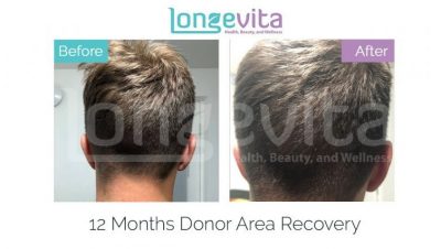 Hair Transplant Donor Area: 6 Tips For Speedy Recovery | Longevita