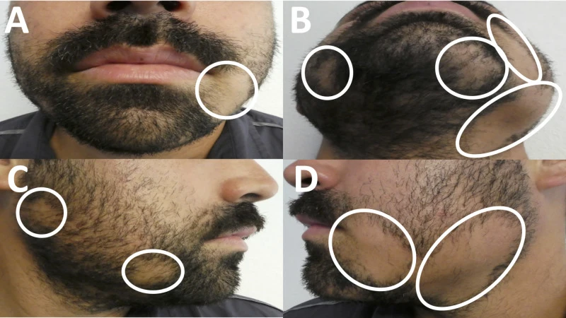 Alopecia Barbae: What It Is, Causes & Treatments