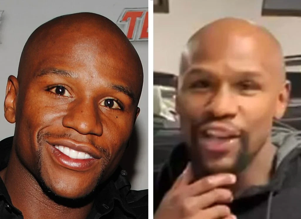 Floyd Mayweather Beard Transplant: Just A Rumour?