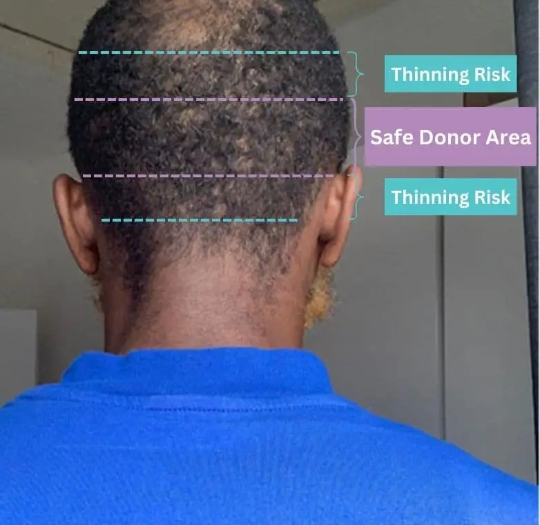 Overharvested Donor Area: Causes & How To Fix It | Longevita