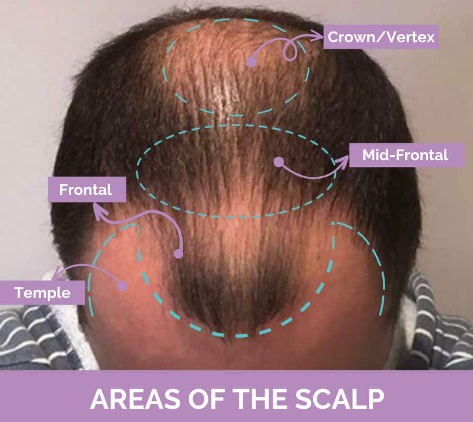 Vertex Thinning Hair