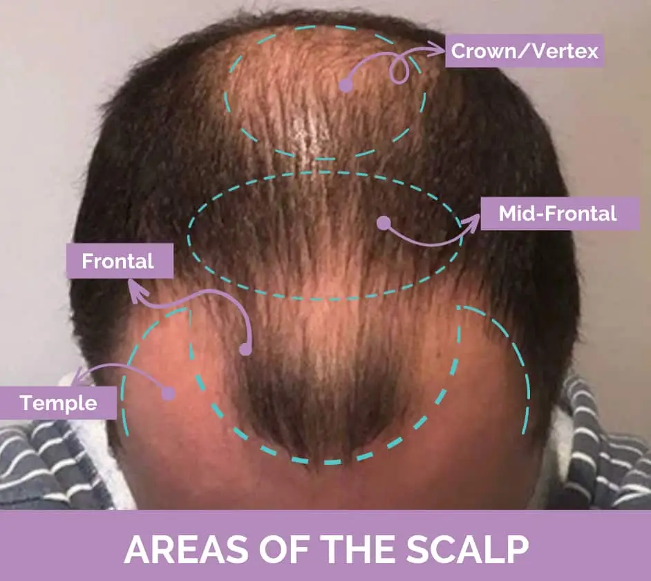 Bald spot on crown store