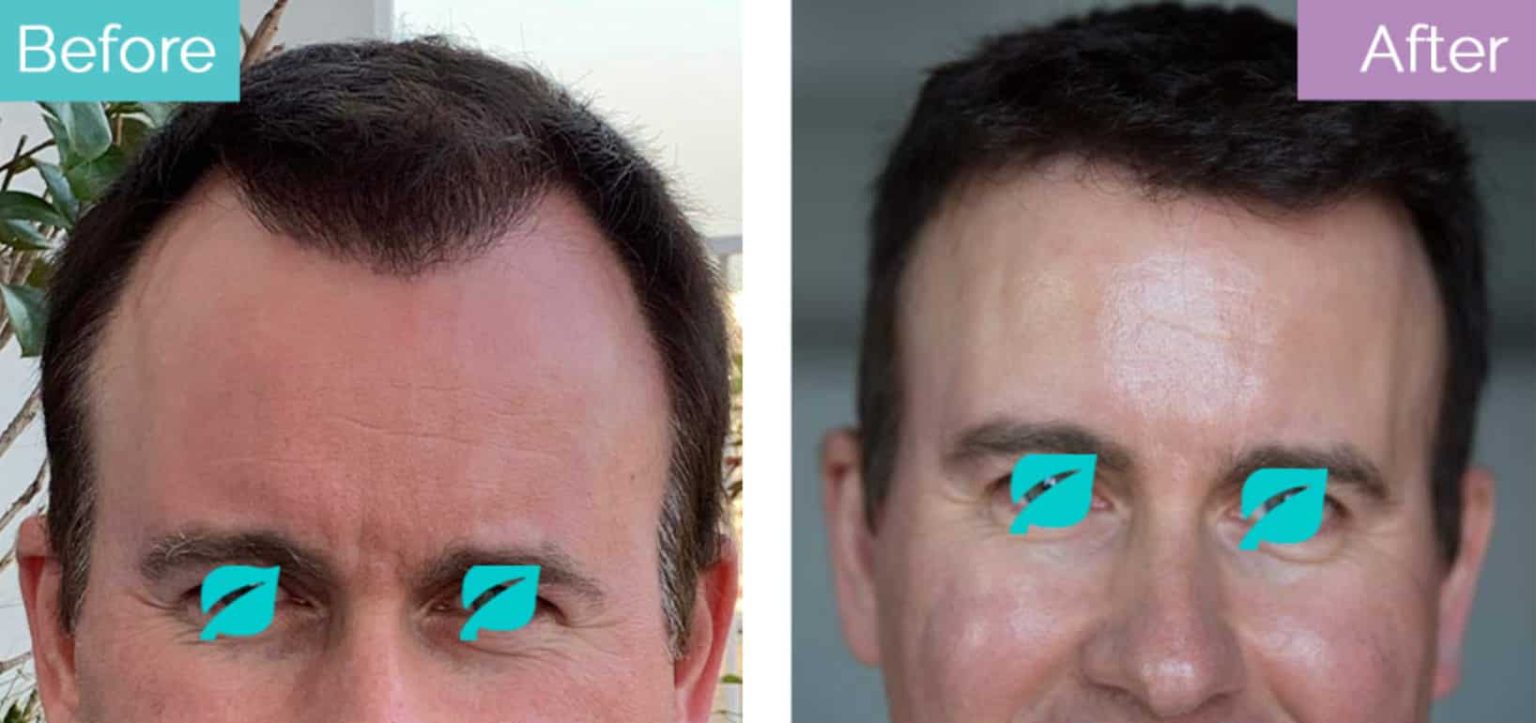 Temple Hair Loss: Why It’s Happening & What You Can Do