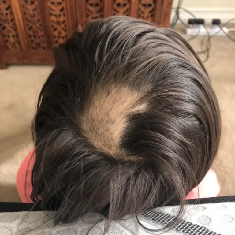 Bald Spot On Crown: How It Looks, Causes & Treatments