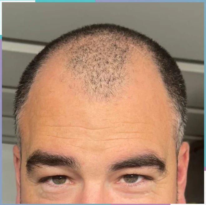 Bald Spot On Crown: How It Looks, Causes & Treatments