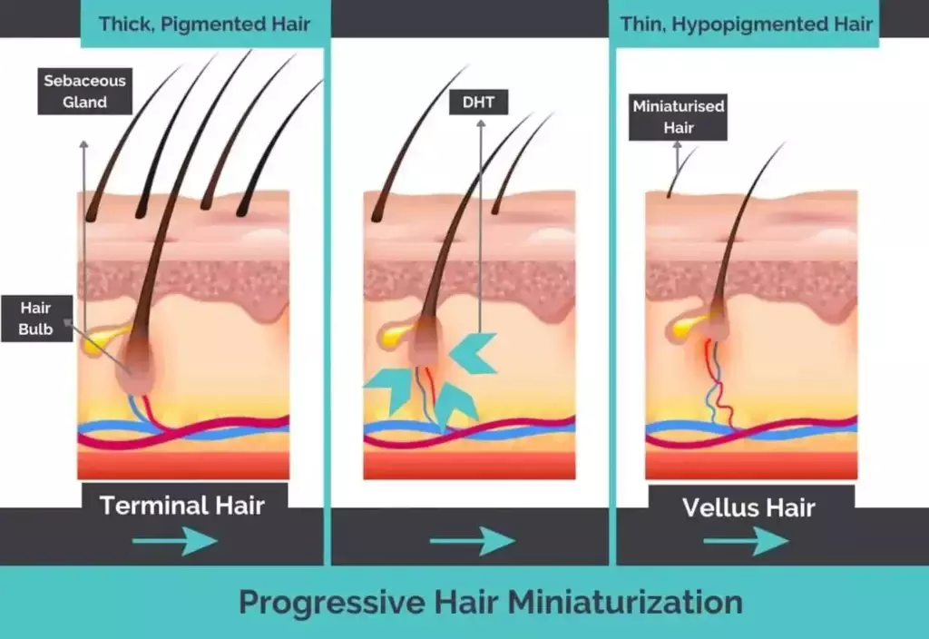Hair Miniaturization: Signs, Causes & Treatments