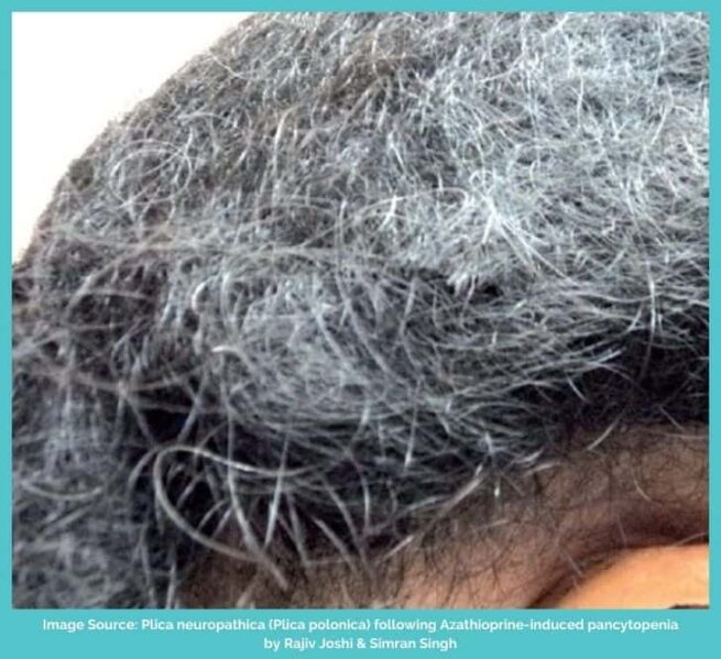Plica Polonica (Polish Plait): Causes & Treatments