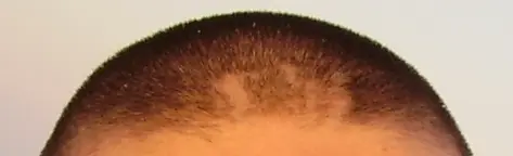 Traumatic Alopecia: Causes, Reversibility & Treatments