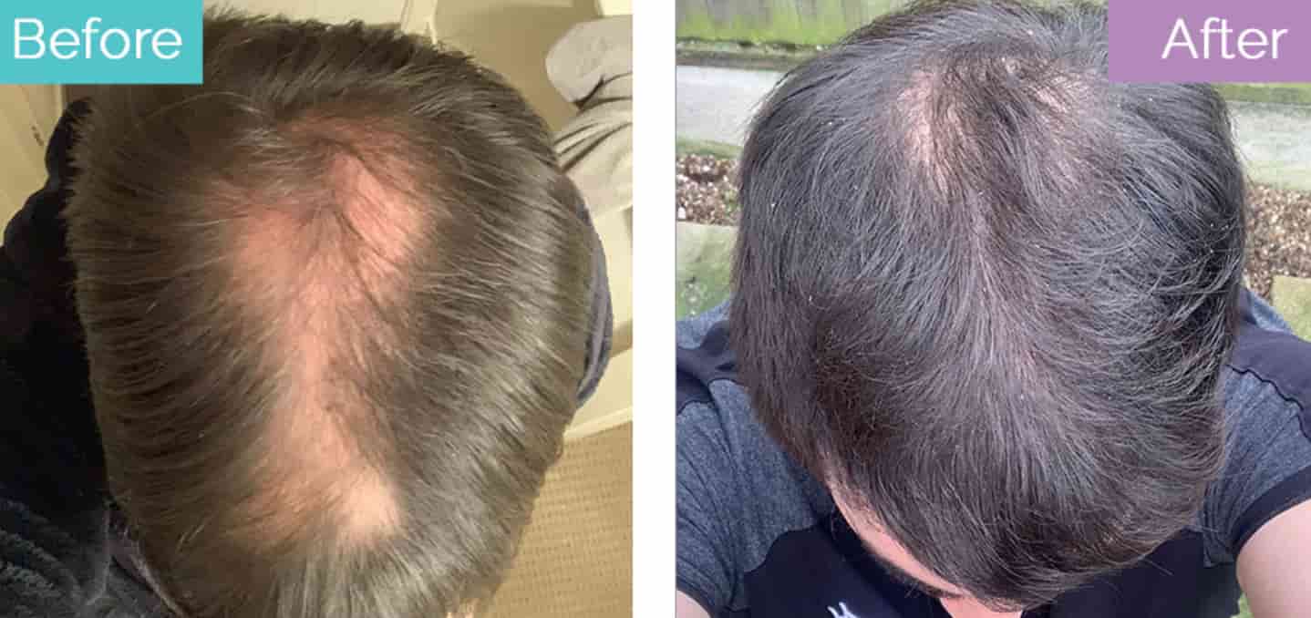 Friction Alopecia: Causes & Treatments | Longevita
