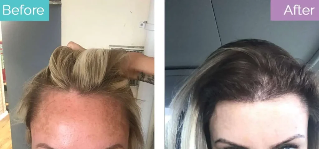 What Is Hairline Lowering Surgery? | Longevita