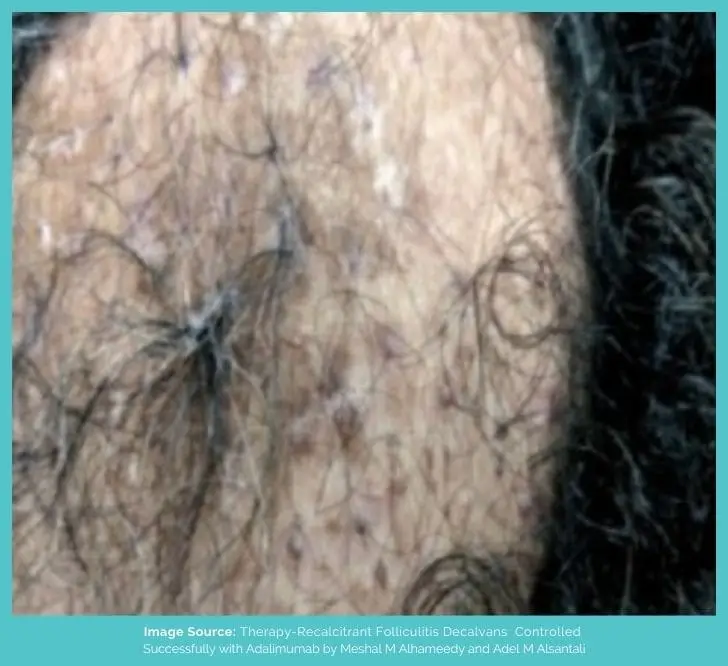Folliculitis Decalvans: What It Is, Causes & Treatments