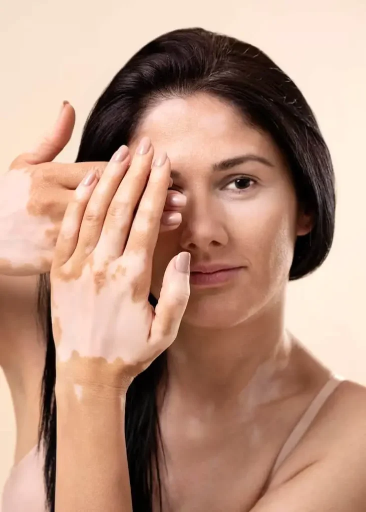18 Autoimmune Diseases That Cause Hair Loss | Longevita