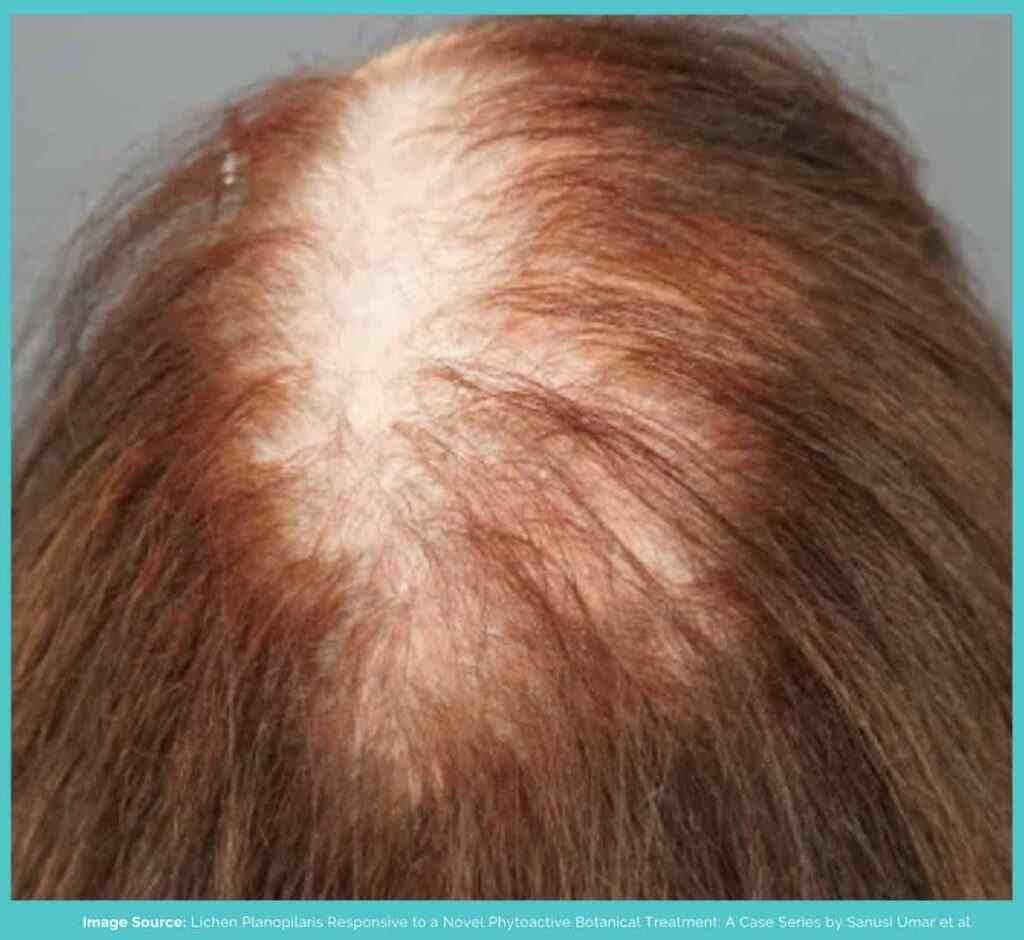 Scarring Alopecia: How It Looks, Reversibility & Treatments