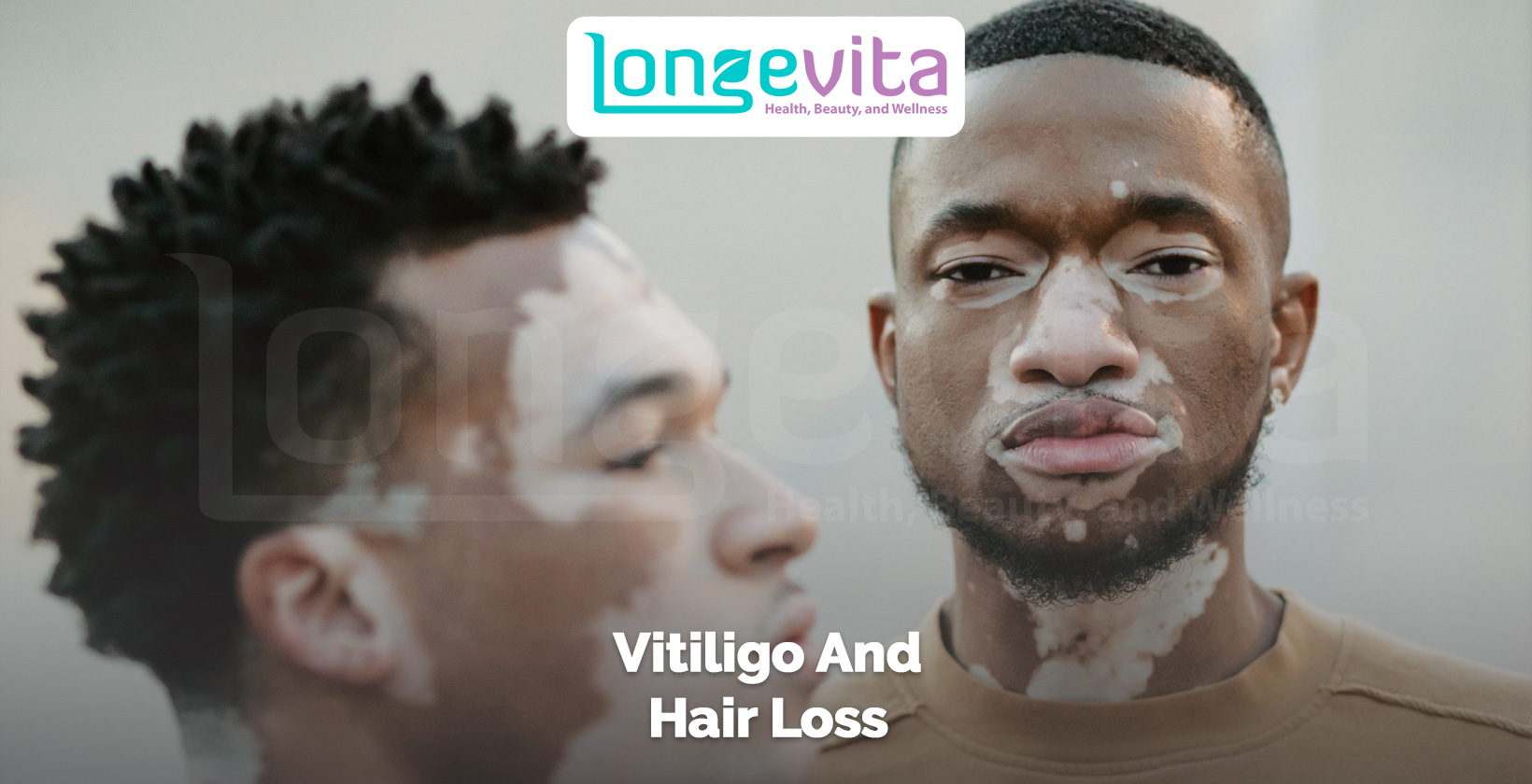 Does Vitiligo Cause Hair Loss? | Longevita
