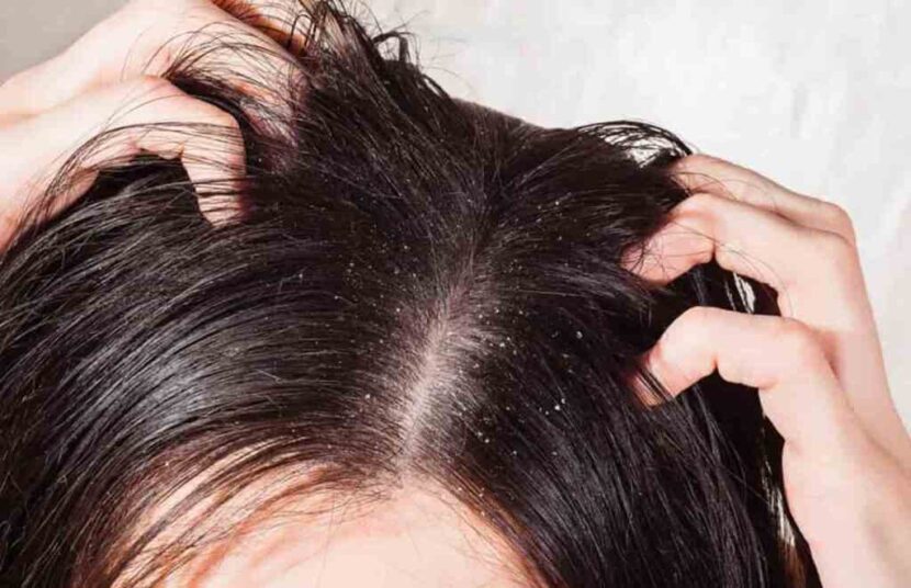 Period Hair Loss: Causes, How To Stop & Prevent | Longevita