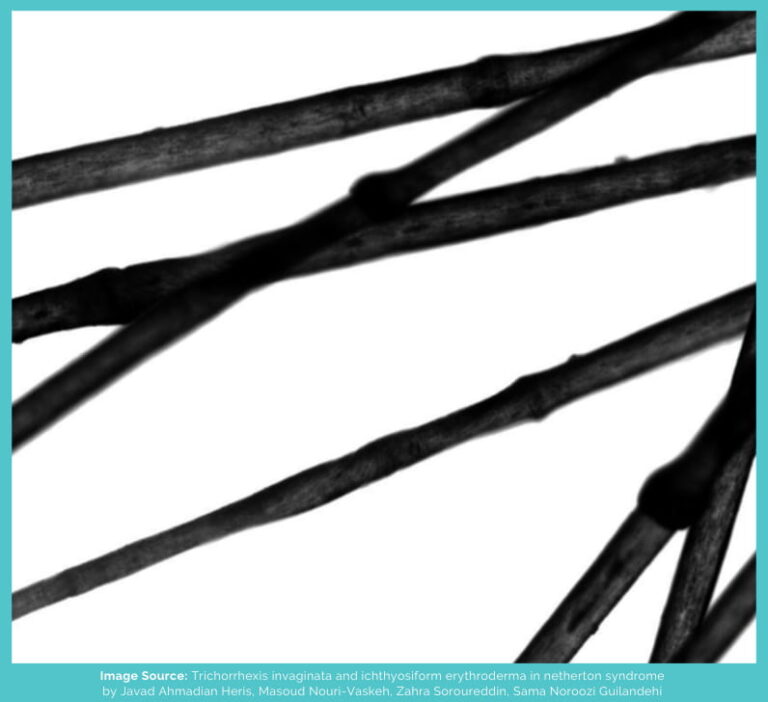 Trichorrhexis Invaginata (Bamboo Hair): What It Is