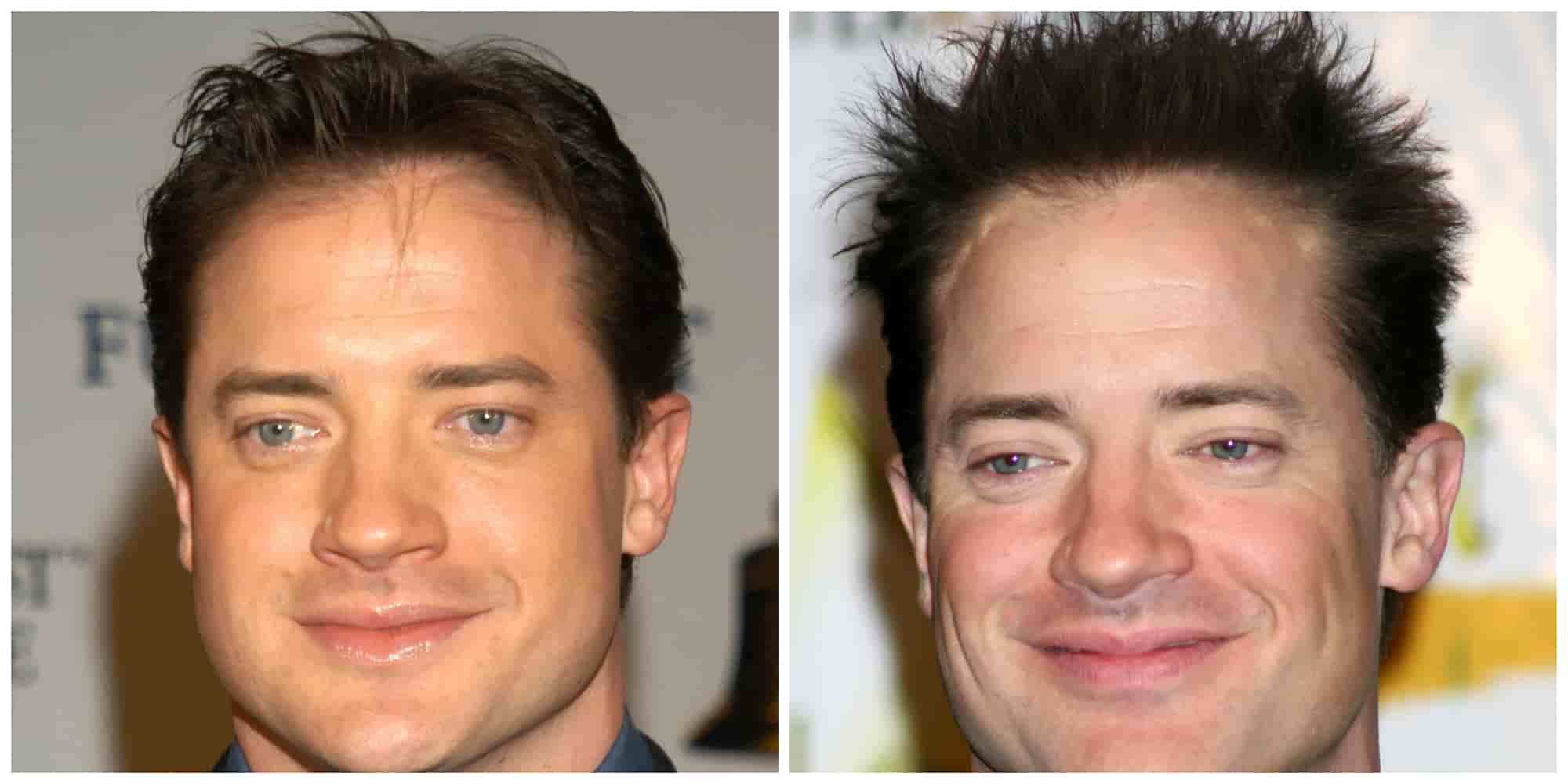 Brendan Fraser Hair Transplant