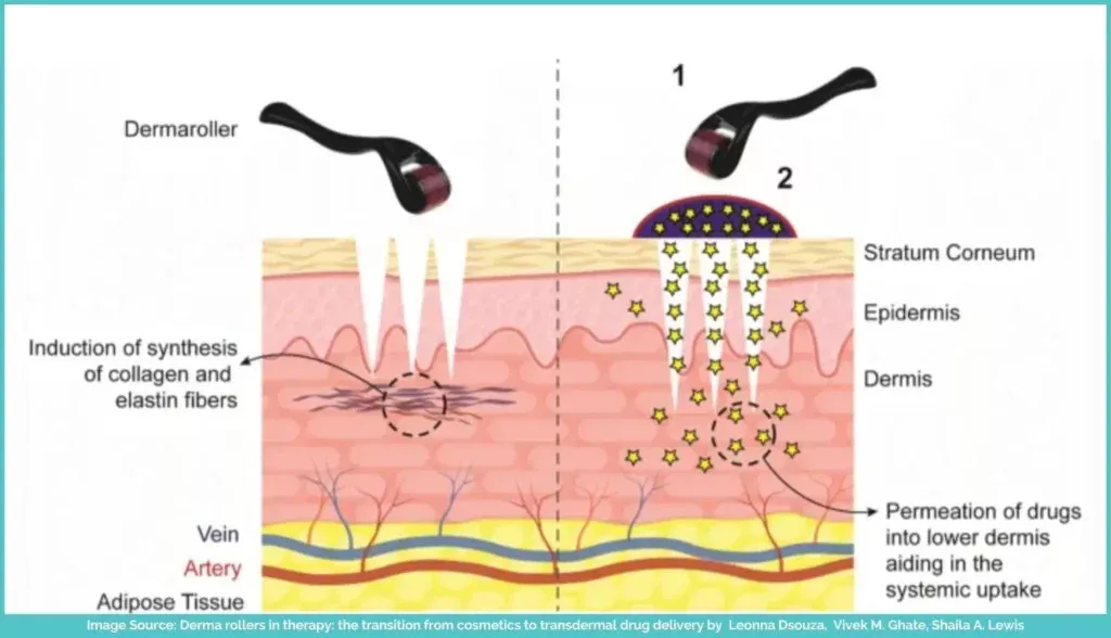 Derma Roller For Hair Growth: How To Use, Benefits & Harms