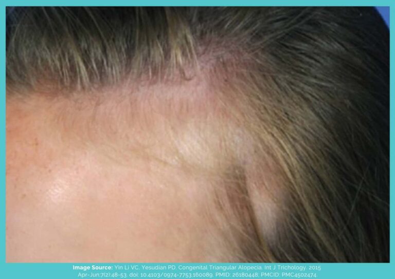 What Is Congenital Triangular Alopecia? | Longevita