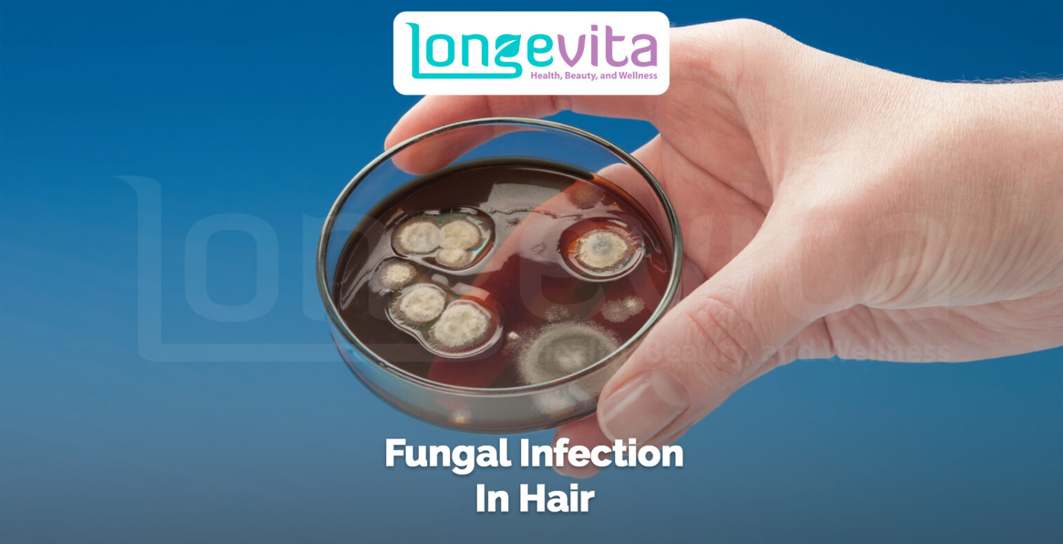 Fungal Infection In Hair: How It Looks & Treatment