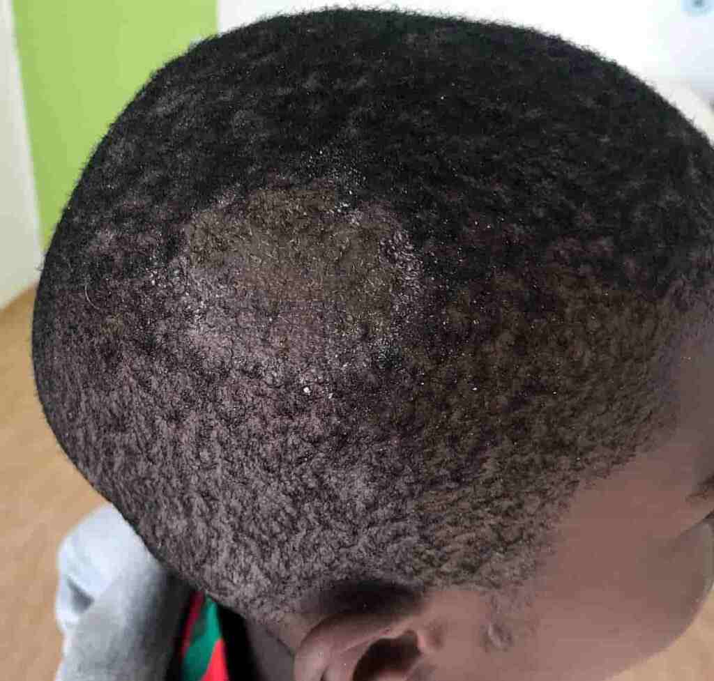 Fungal Infection In Hair: How It Looks & Treatment