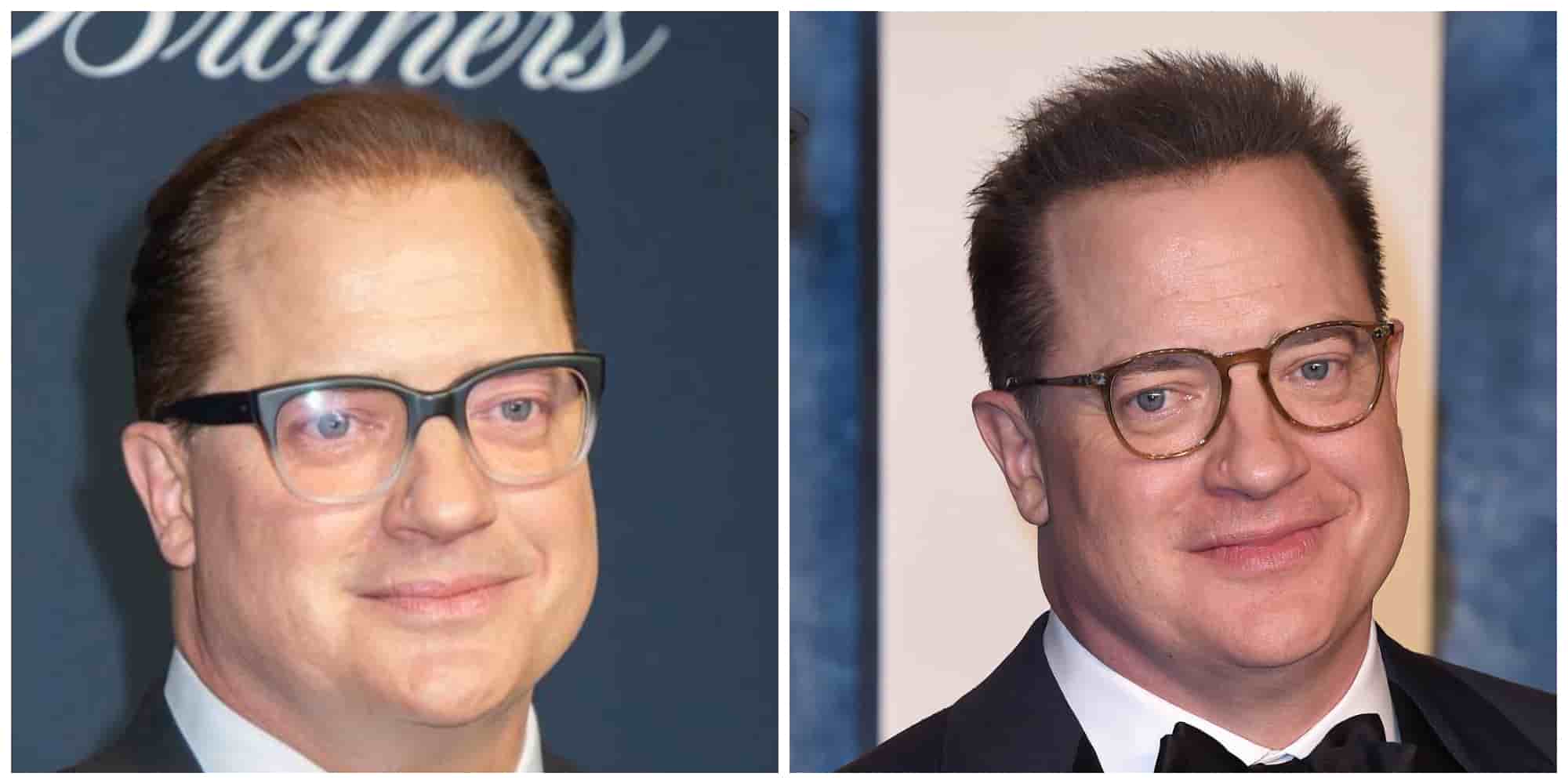 Has Brendan Fraser Had A Hair Transplant? | Longevita