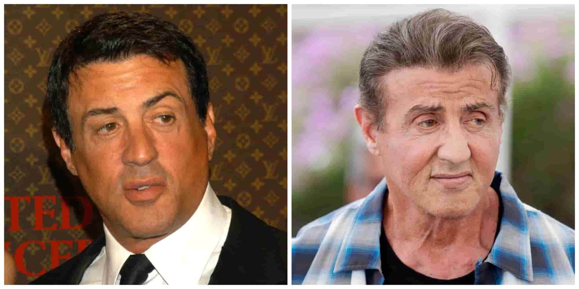 Has Sylvester Stallone Had A Hair Transplant? | Longevita