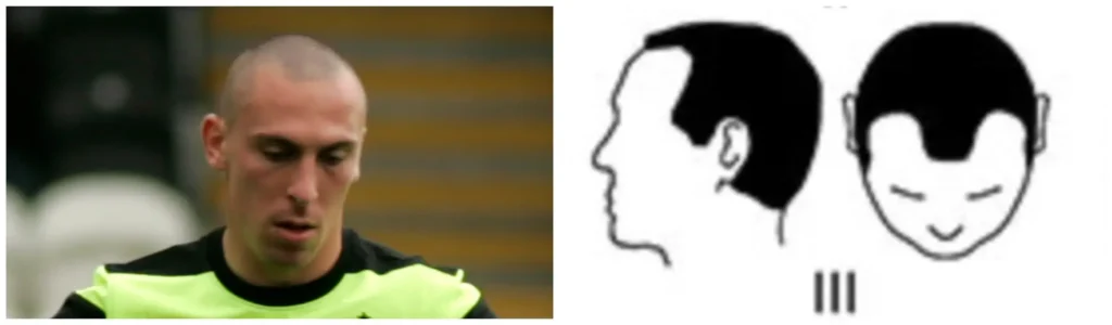 Has Scott Brown Had A Hair Transplant? | Longevita
